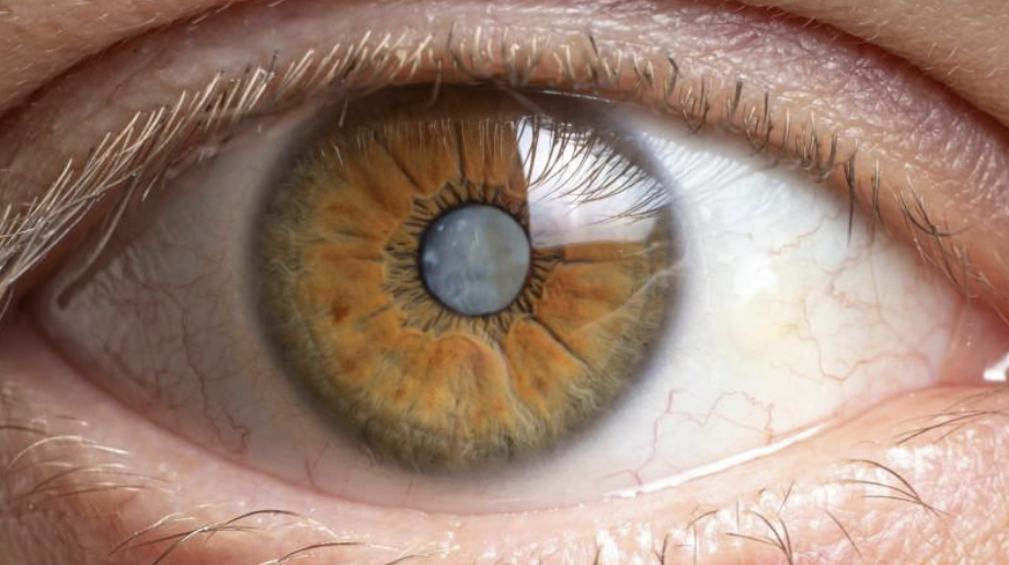 Cataracts - Eye Review